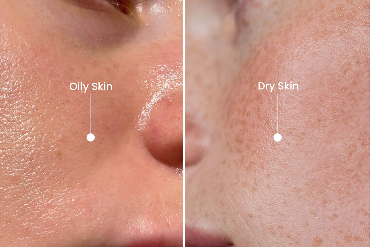 Oily vs. Dry Skin: How to Choose the Right Cream for Your Skin Type ...